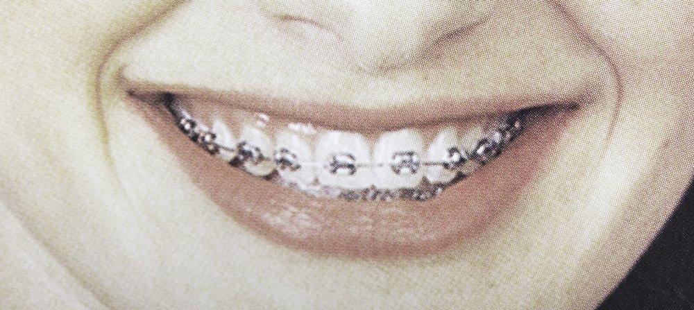 Silver Braces Color