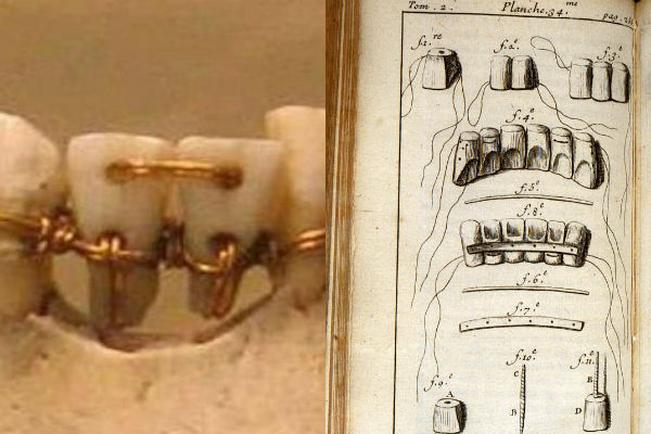 History Of Braces They Used To Do What Edmonton Orthodontist