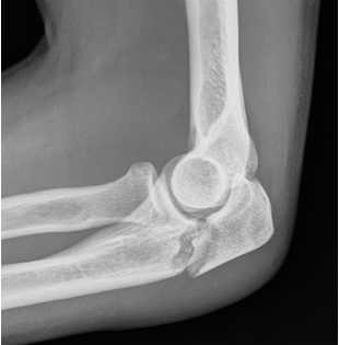 Fratura do olécrano — Dr. Eduardo Malavolta
