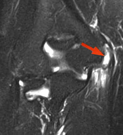 Epicondilite medial — Dr. Eduardo Malavolta