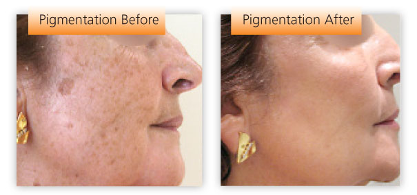 Uremic Frost On Skin