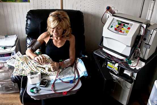 Are Lumps & Bumps On Chronic Kidney Disease-Dialysis Patients' AV ... Are Lumps & Bumps On Chronic Kidney Disease-Dialysis Patients' AV ...