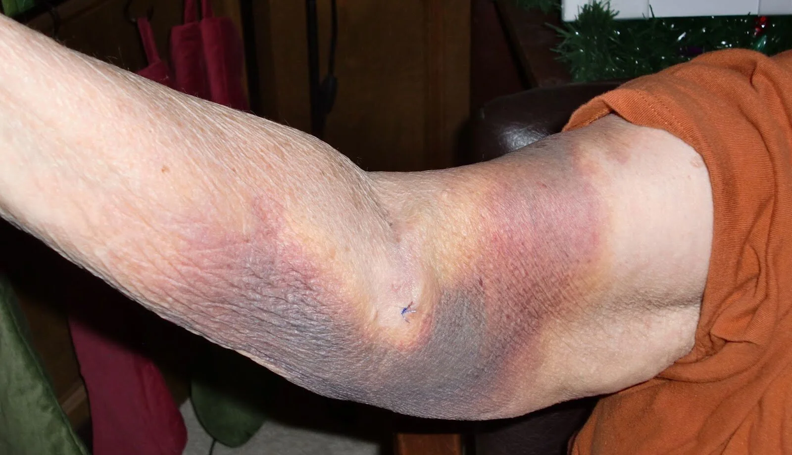 KidneyBuzz.com: Chronic Kidney Disease Information, Dialysis Tips ...