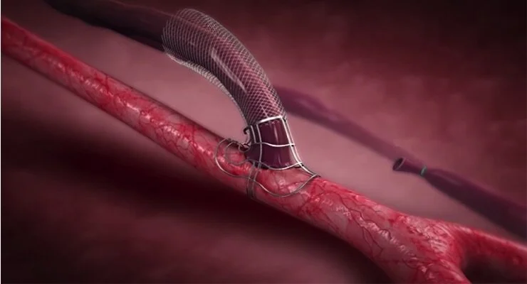 KidneyBuzz.com: Chronic Kidney Disease Information, Dialysis Tips ...