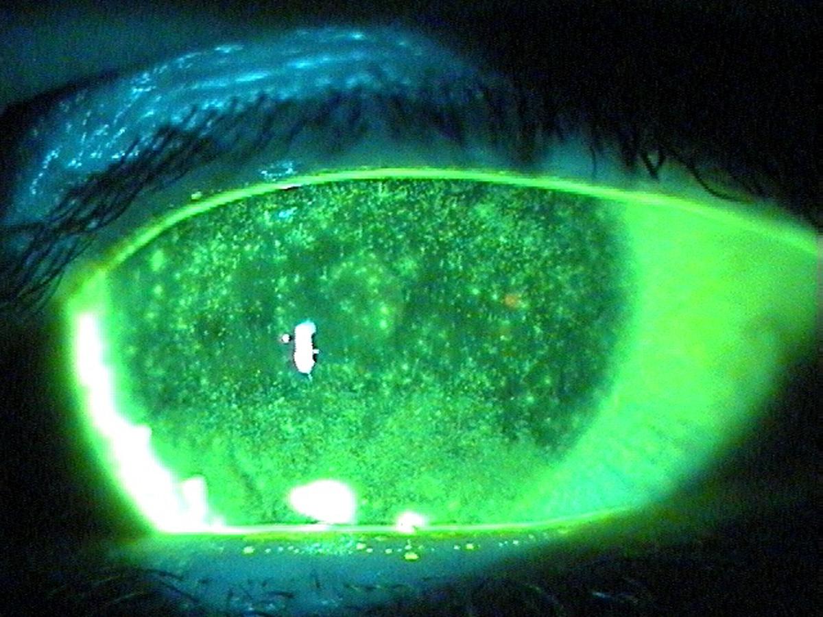 EYE DISEASES — EYE LOVE OPTOMETRY