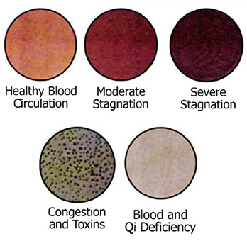 Cupping for the Non-Olympian — Lovie Acupuncture and Healing