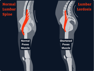 Psoas Talk with Christye: Is Your Athlete's Hip Pain a Flexibility or ...