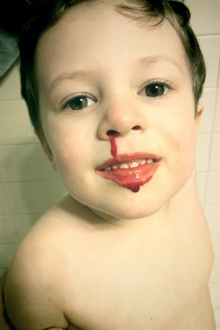 Nosebleeds in children (epistaxis) — Mr Daniel Tweedie - Consultant ...