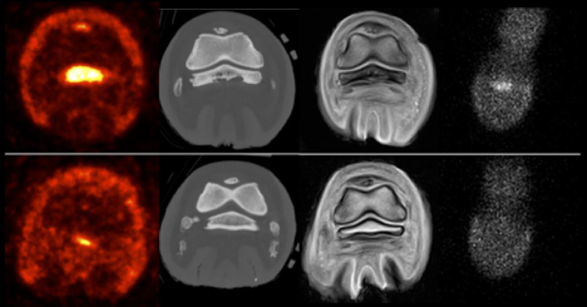 PET scanning - reduces catastrophic fractures - latest advance in ...