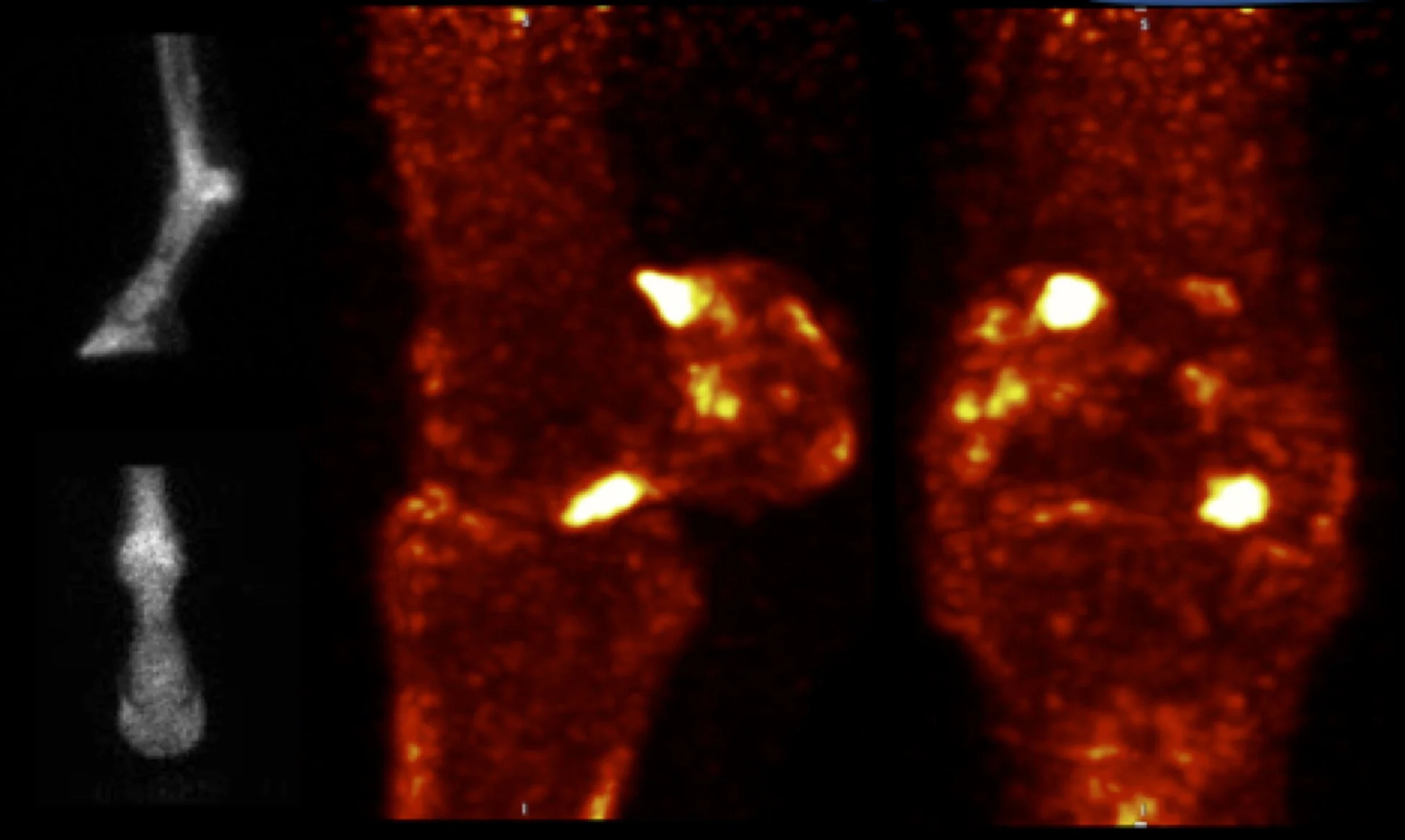 PET scanning - reduces catastrophic fractures - latest advance in ...