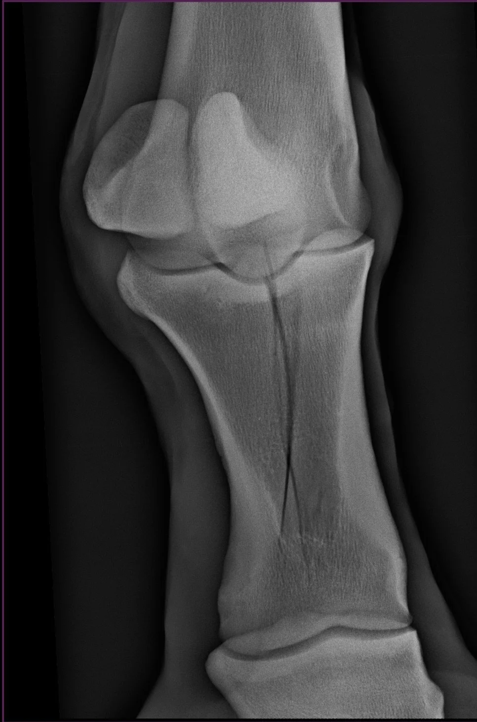 Fracture — North American Article Index | Trainer Magazine