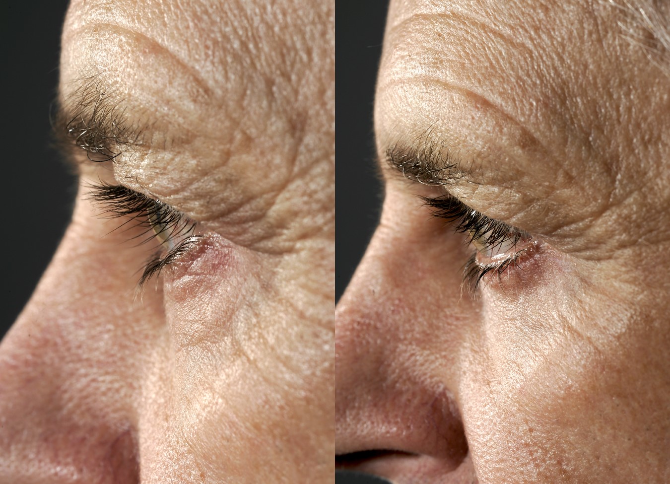 Best Blepharoplasty In New York City — Lara Devgan Md Mph Facs