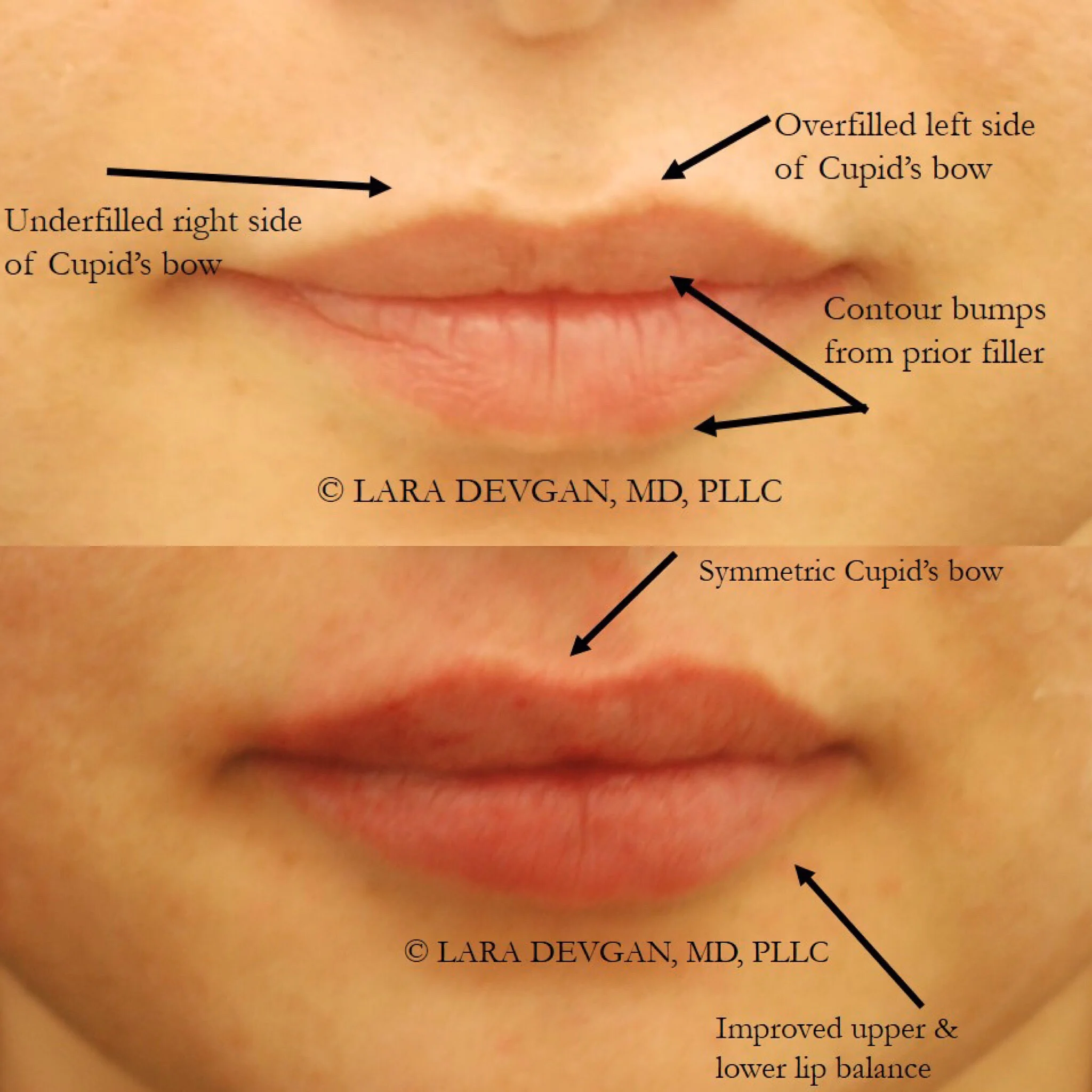 Lump And Bump Difference Lump And Bump Difference