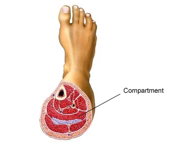 Crush Injury — REAL First Aid
