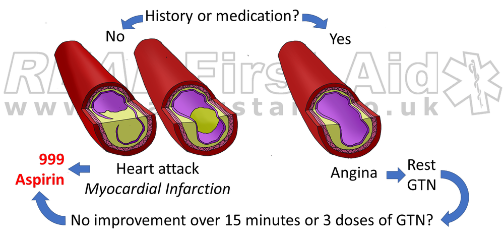 Understanding Chest Pain: Part 1 - Heart Attack & Angina — REAL First Aid