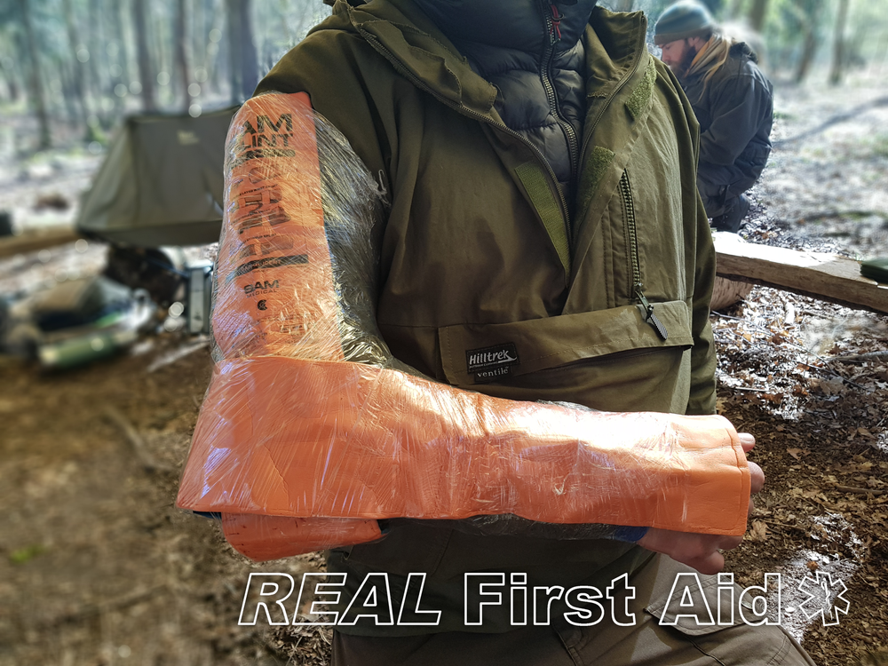 SAM Splints — REAL First Aid