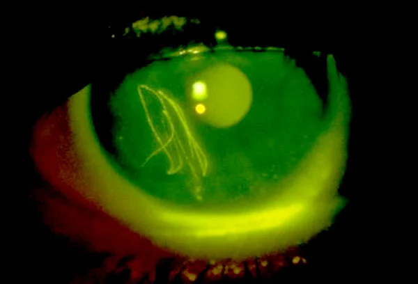 Eye Injuries — REAL First Aid
