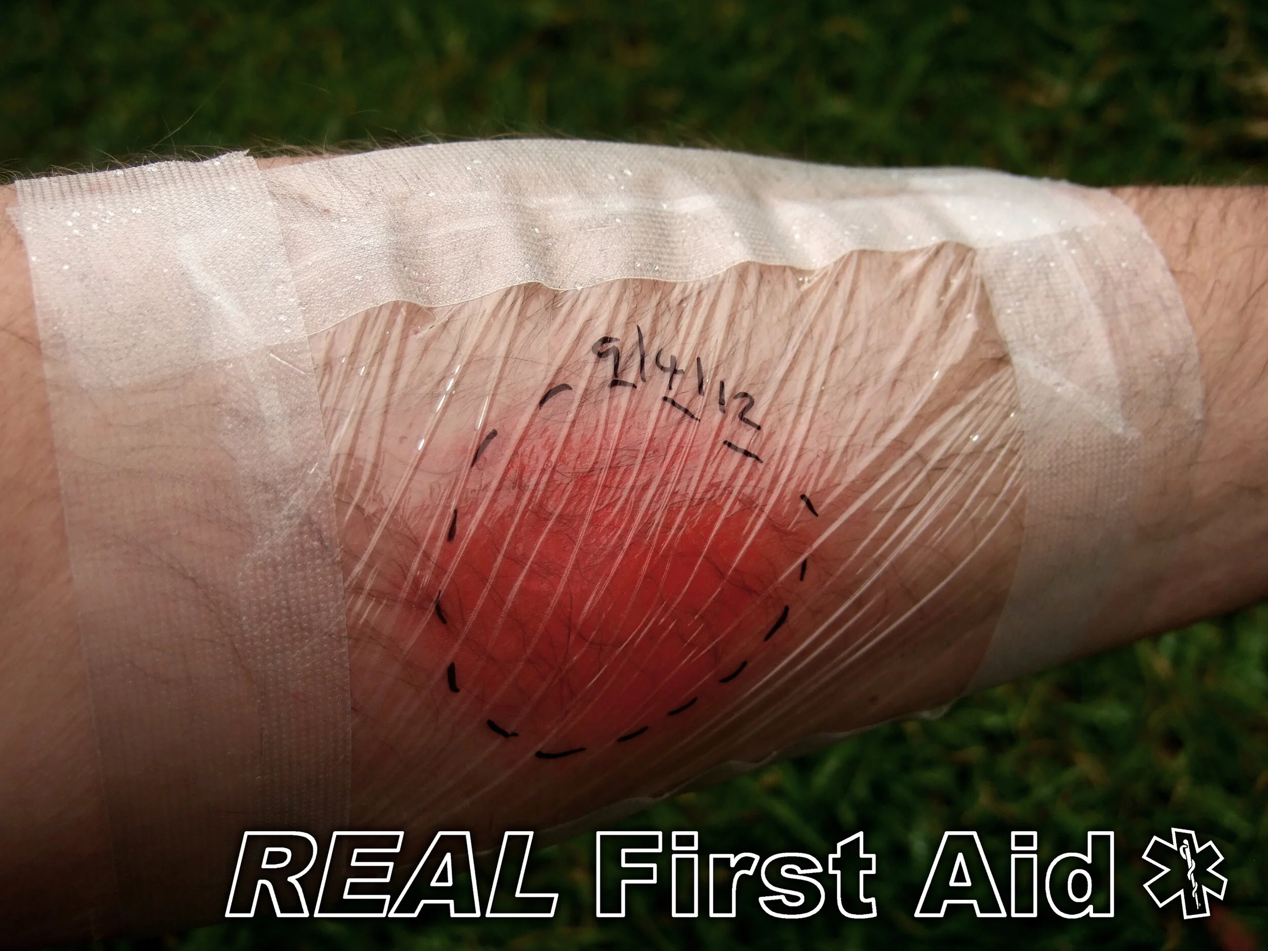 Cling Film? The Next Generation — REAL First Aid