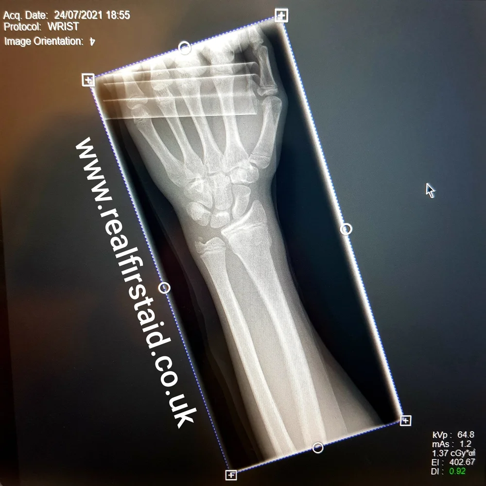 SAM Splints — REAL First Aid