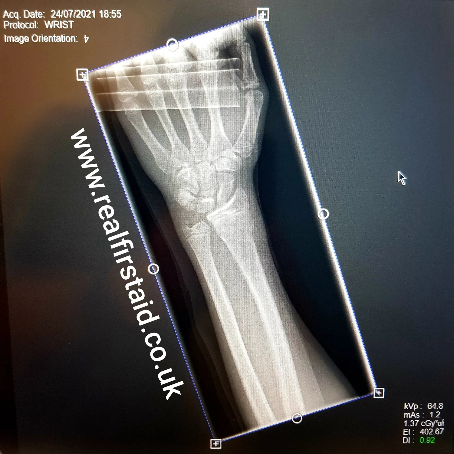 SAM Splints — REAL First Aid