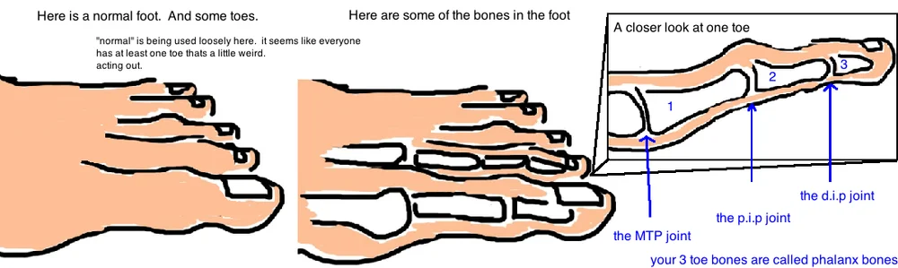 Pinky Toe Hammer Toe