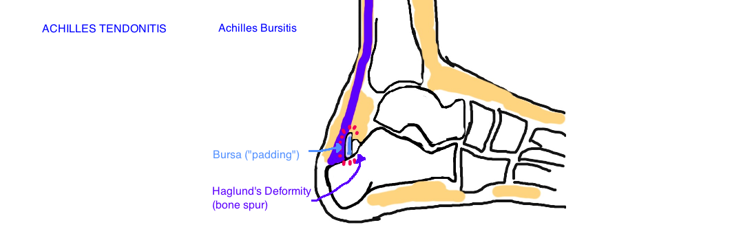 Achilles Tendonitis — Bone Talks