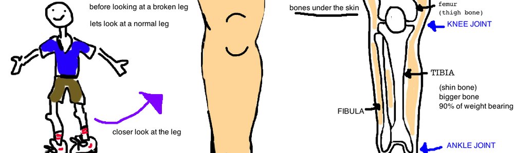 Broken Bones Through Skin