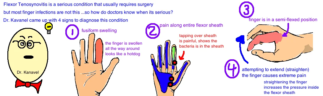 Nailbed and Finger Infections — Bone Talks