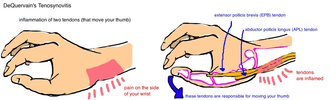 DeQuervain's Tenosynovitis — Bone Talks