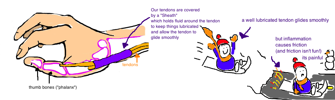 DeQuervain's Tenosynovitis — Bone Talks