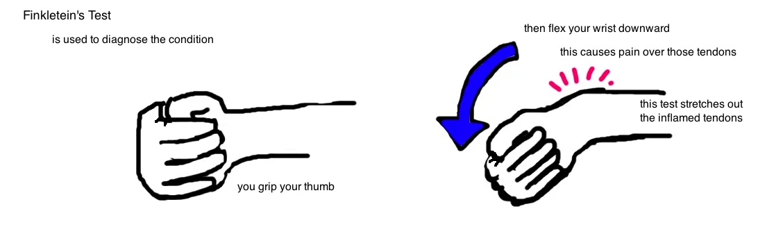 DeQuervain's Tenosynovitis — Bone Talks