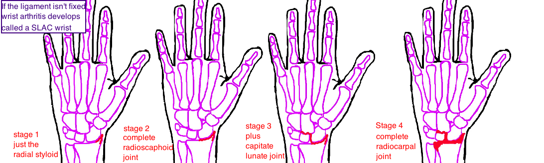 Scapho-Lunate Dissociation — Bone Talks