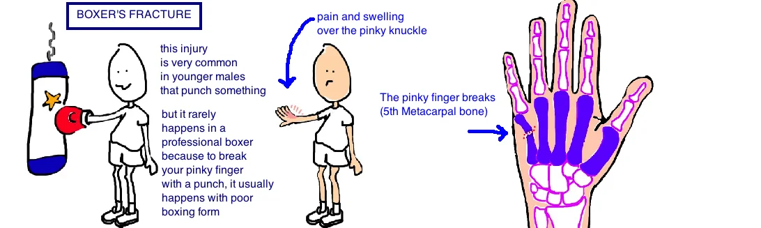 Broken Hand (Metacarpal Fracture) — Bone Talks