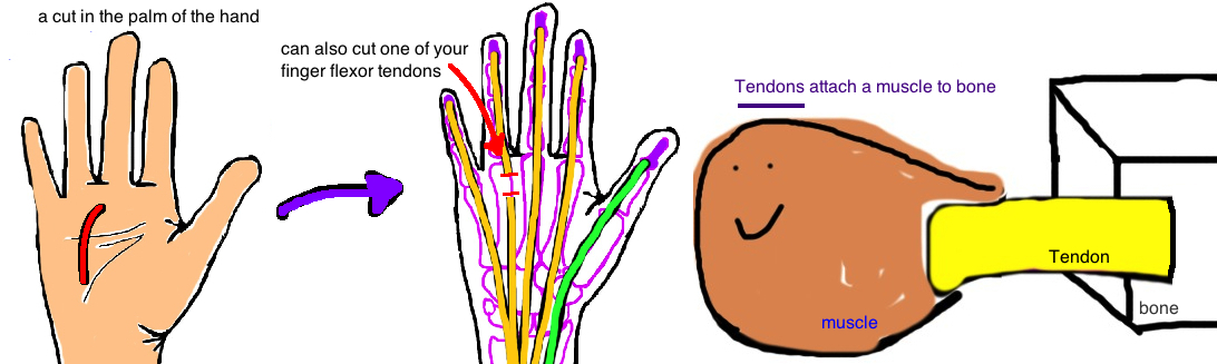 Hand Flexor Tendon Laceration — Bone Talks