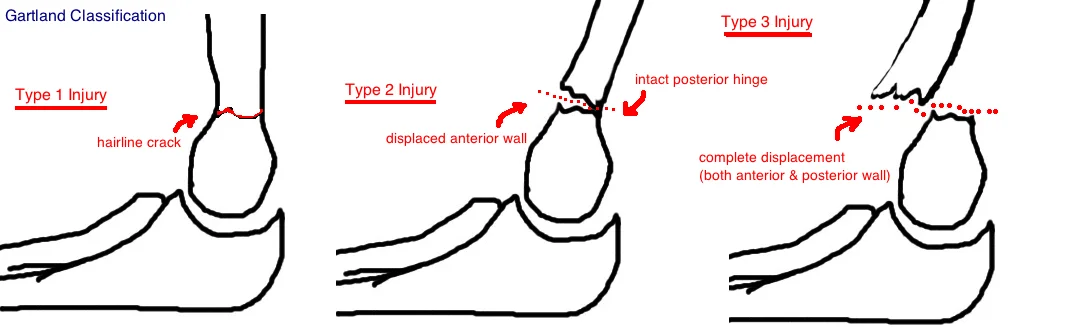 Kids - Broken Elbow (Supracondylar Fracture) — Bone Talks