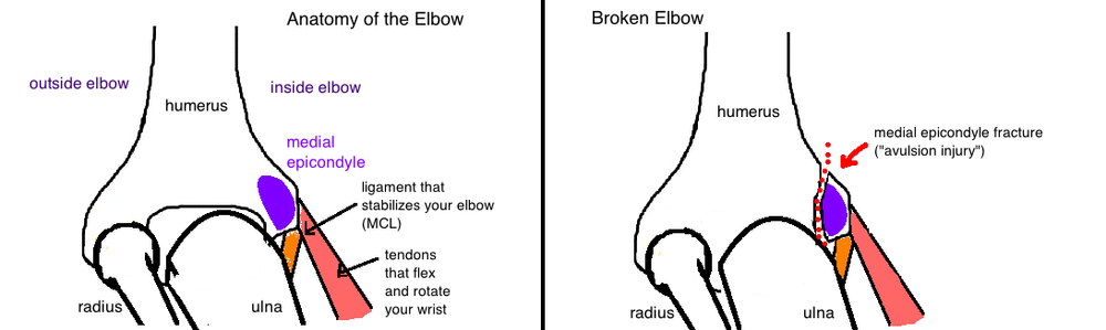 Medial Epicondyle Of Ulna
