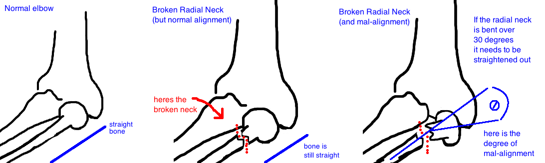 Kids - Radial Neck Fracture — Bone Talks