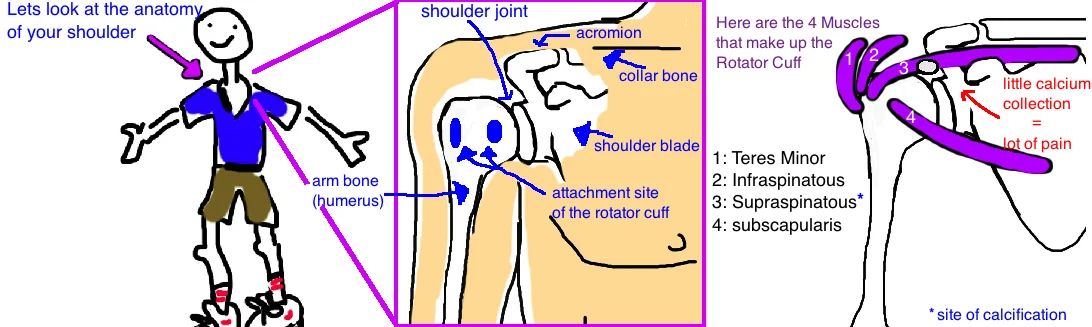 New Advances in Treatment for Calcific Tendonitis of the Shoulder ...