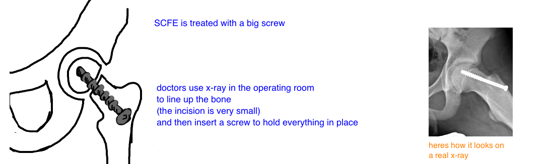 Kids - SCFE (Slipped Capital Femoral Epiphysis) — Bone Talks