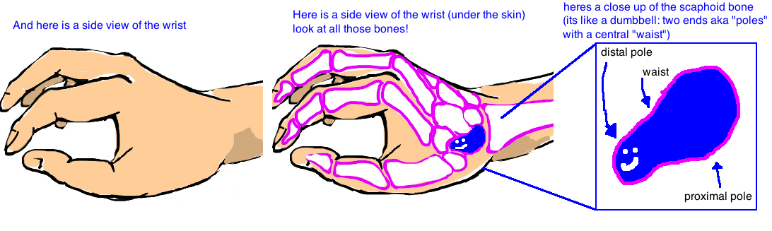 Scaphoid Fracture — Bone Talks