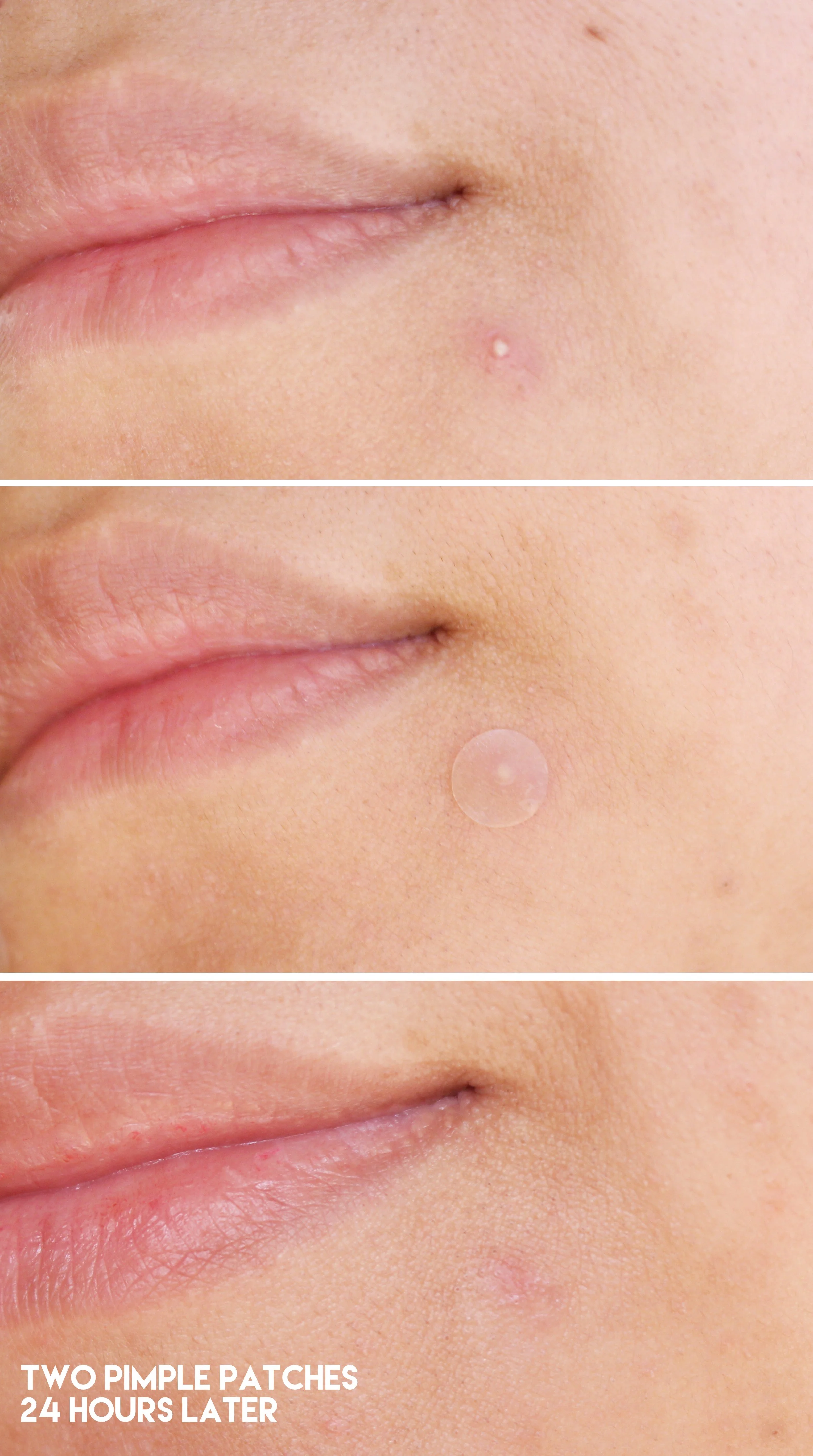 Rave + Gross Pics: How The COSRX Acne Pimple Master Patch Works ...