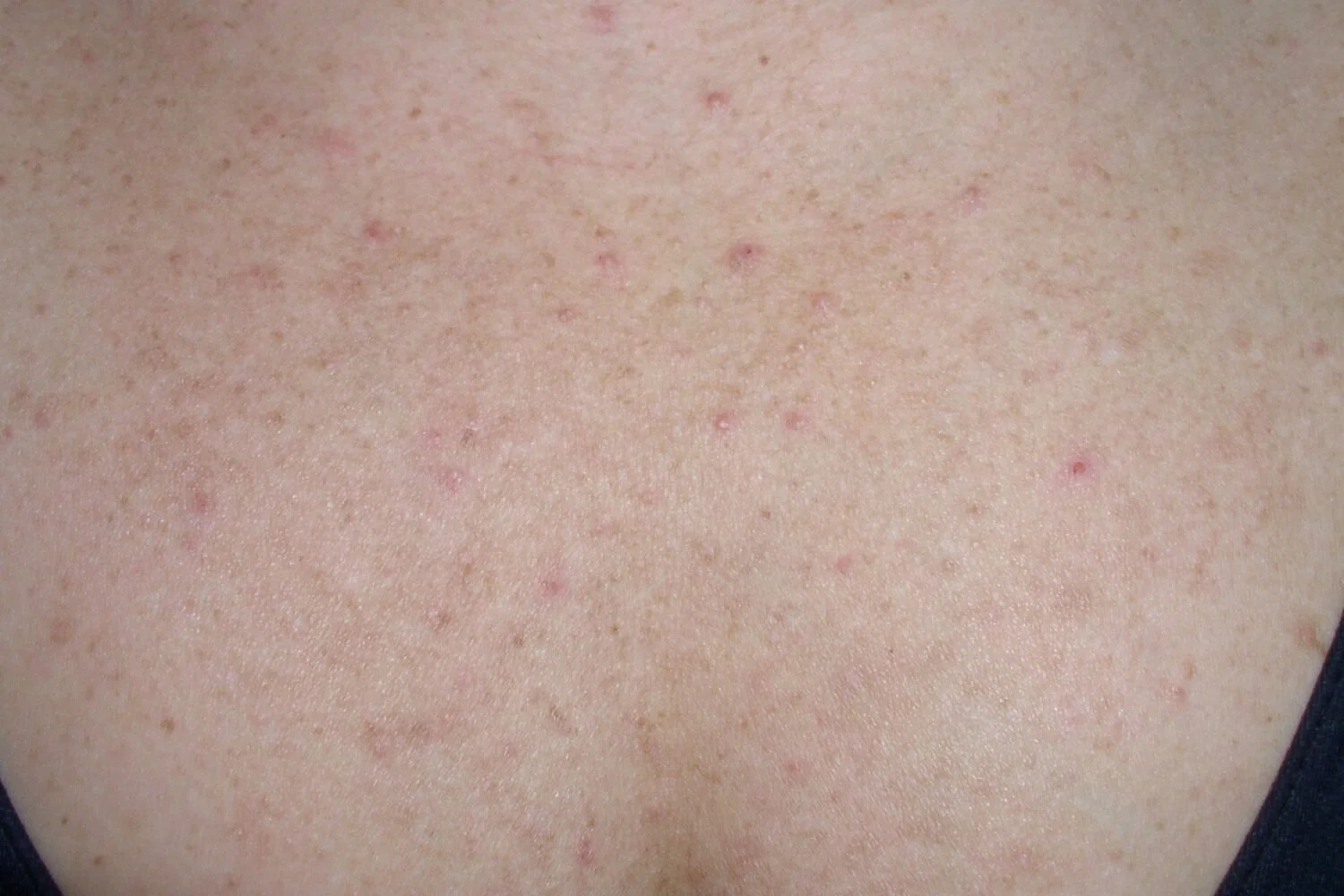 Fungal Acne 101 What It Is How It s Different From A Regular Breakout