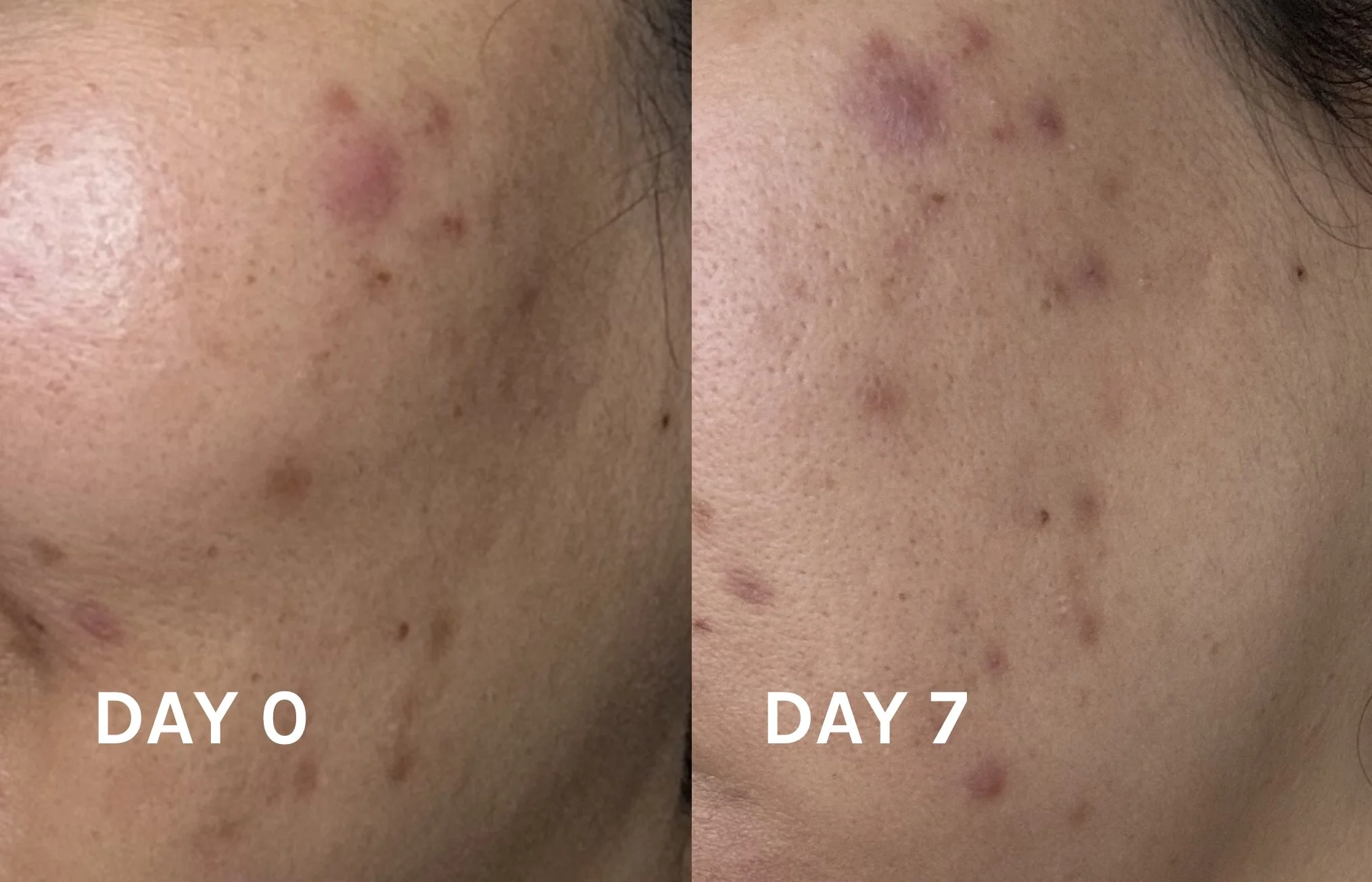 My Epiduo Experience: Day 7 — Project Vanity