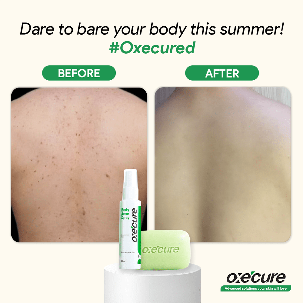 What makes these Oxecure products so effective for body acne? Plus ...