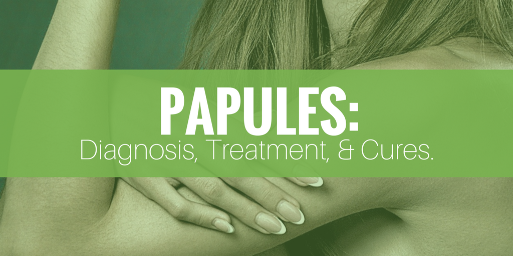 Papules: Diagnosis, Treatment, & Cures — Atlantic Health Solutions