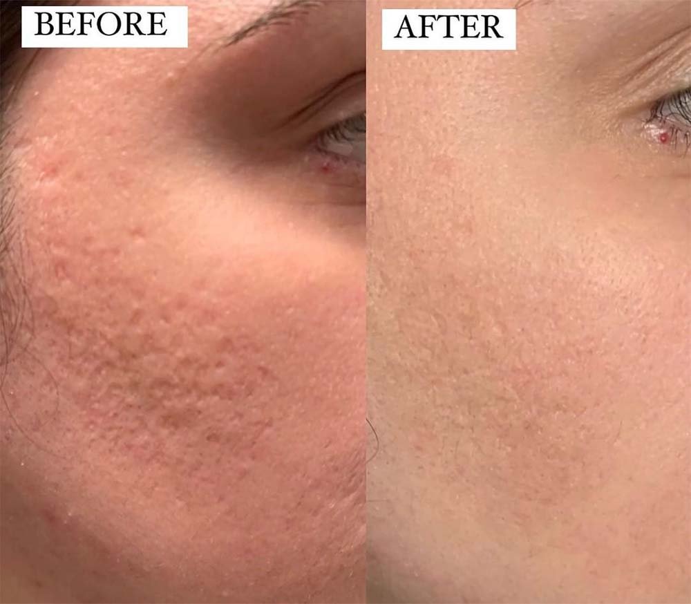 Life Point Acupuncture A Look At Microneedling Before And After
