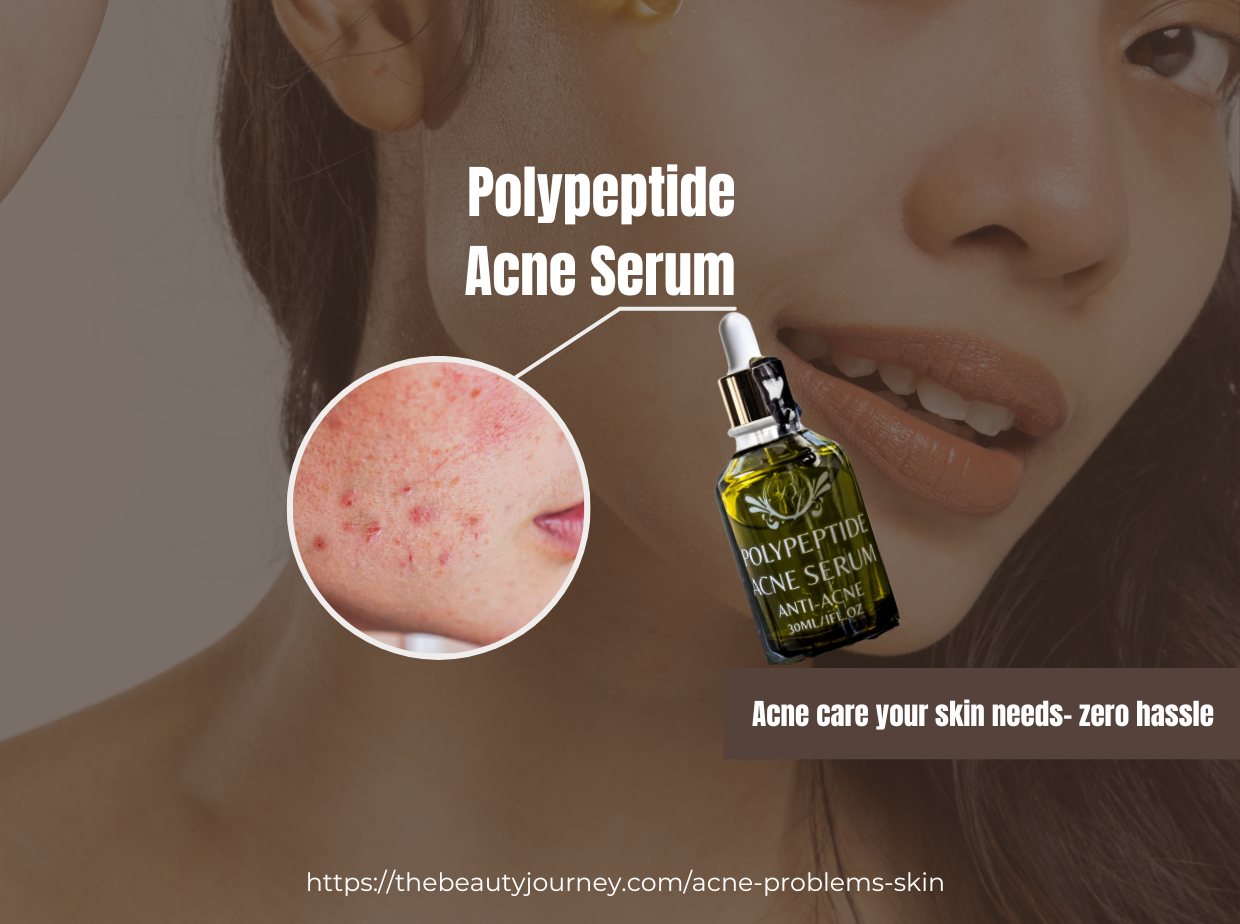 Understanding the How and Why? Say Goodbye to Acne! — Beauty Journey Studio
