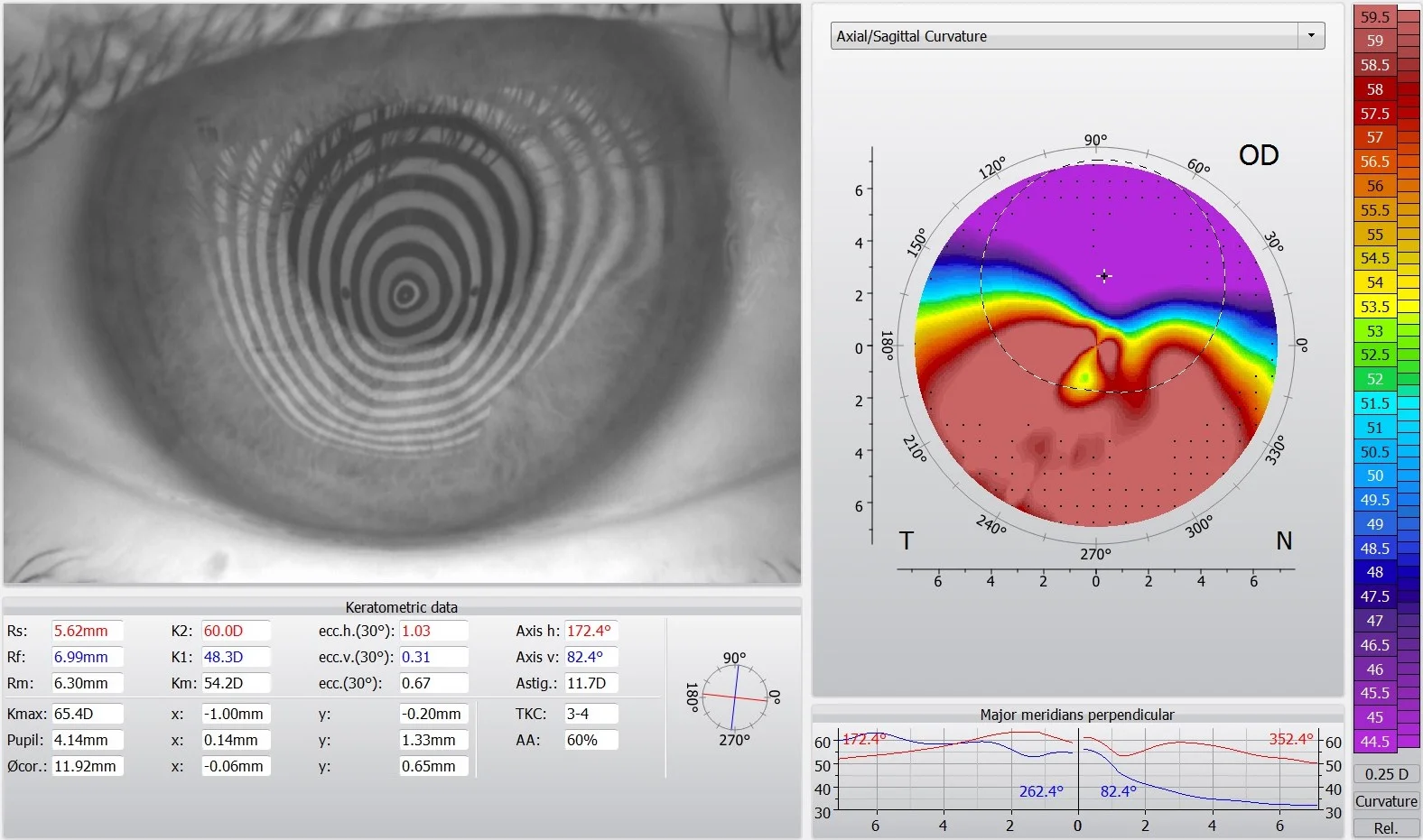 Keratoconus Corneal Topography