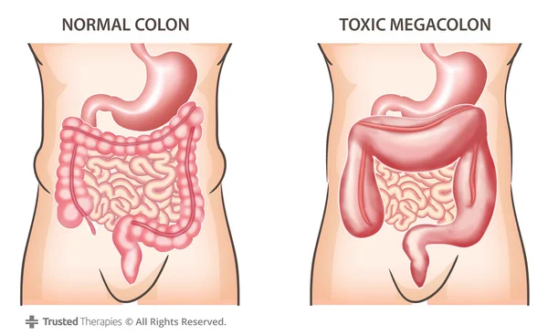 Toxic Megacolon C Diff