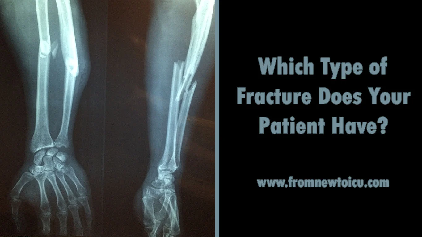 Complicated Fracture